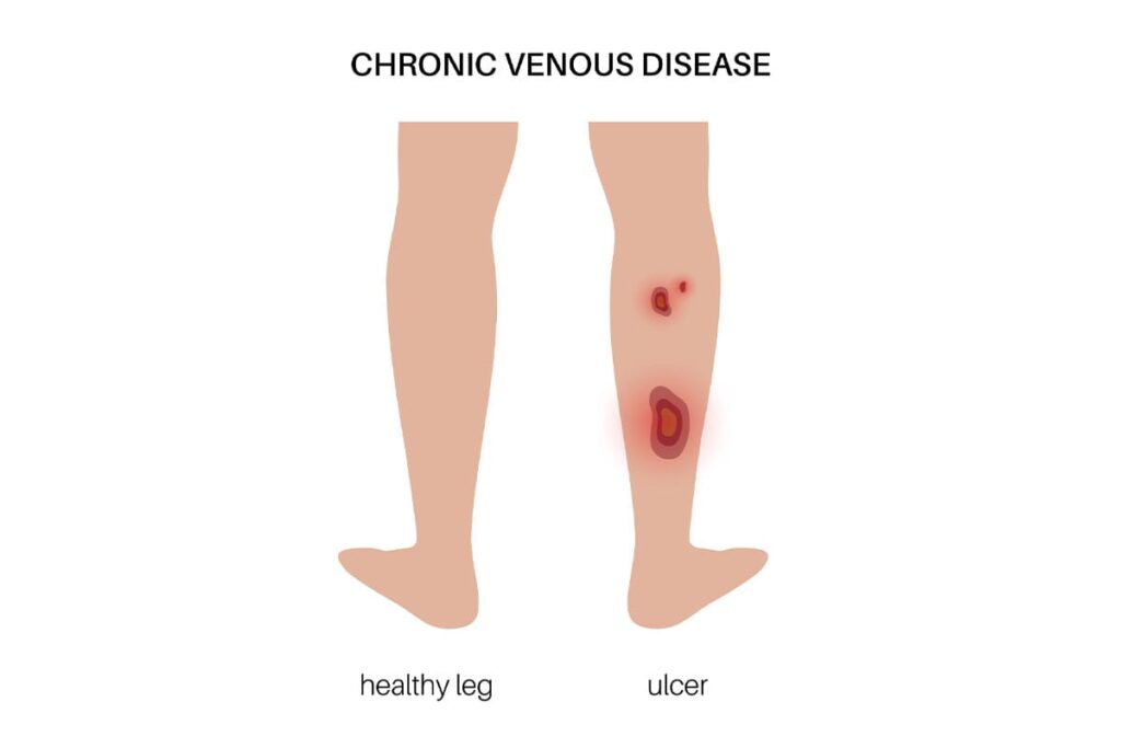 Wound Care St. Louis, MO | St. Louis Vascular Surgical Specialists