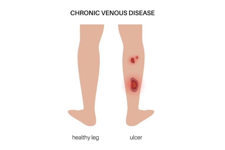 Wound Care St. Louis, MO | St. Louis Vascular Surgical Specialists